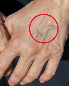 “Understanding Bulging Veins: Common Causes and When to Get Support ...